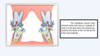 Correction of molar relationship (Elastics) .pptx