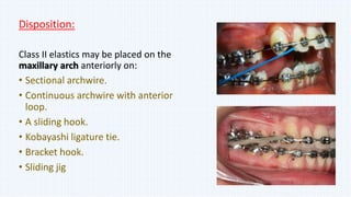 Correction of molar relationship (Elastics) .pptx