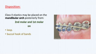 Correction of molar relationship (Elastics) .pptx