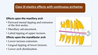Correction of molar relationship (Elastics) .pptx