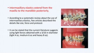 Correction of molar relationship (Elastics) .pptx