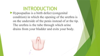 Presentation of hypospadias and epispadias | PPTX