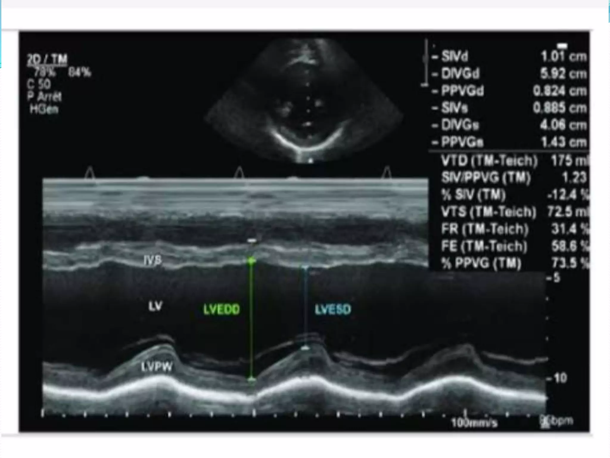 M-mode echo-1-1.pptx