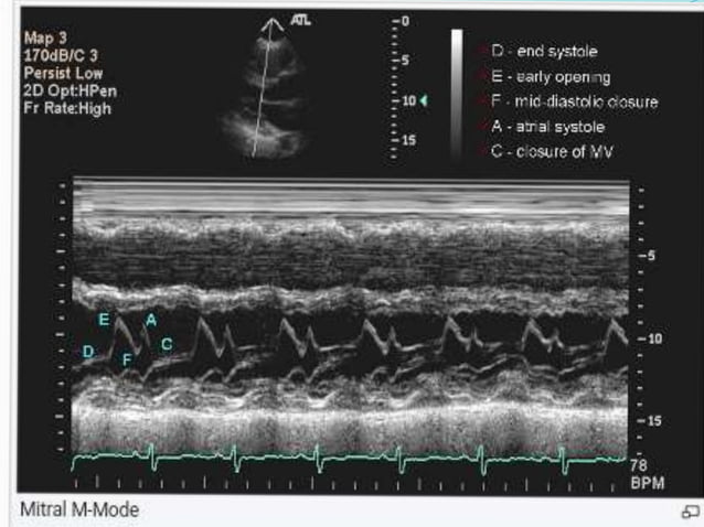 M-mode echo-1-1.pptx