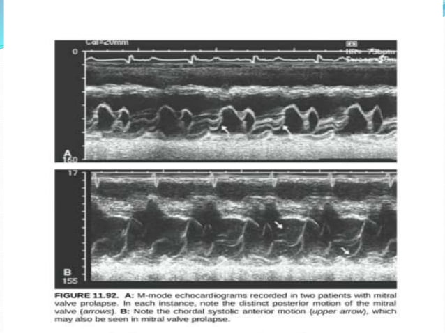 M-mode echo-1-1.pptx