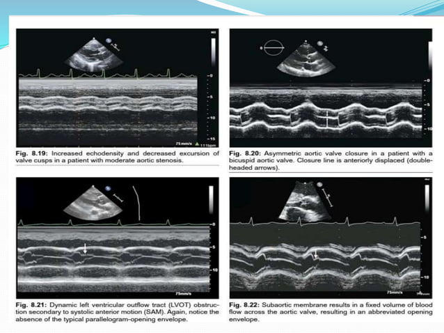 M-mode echo-1-1.pptx