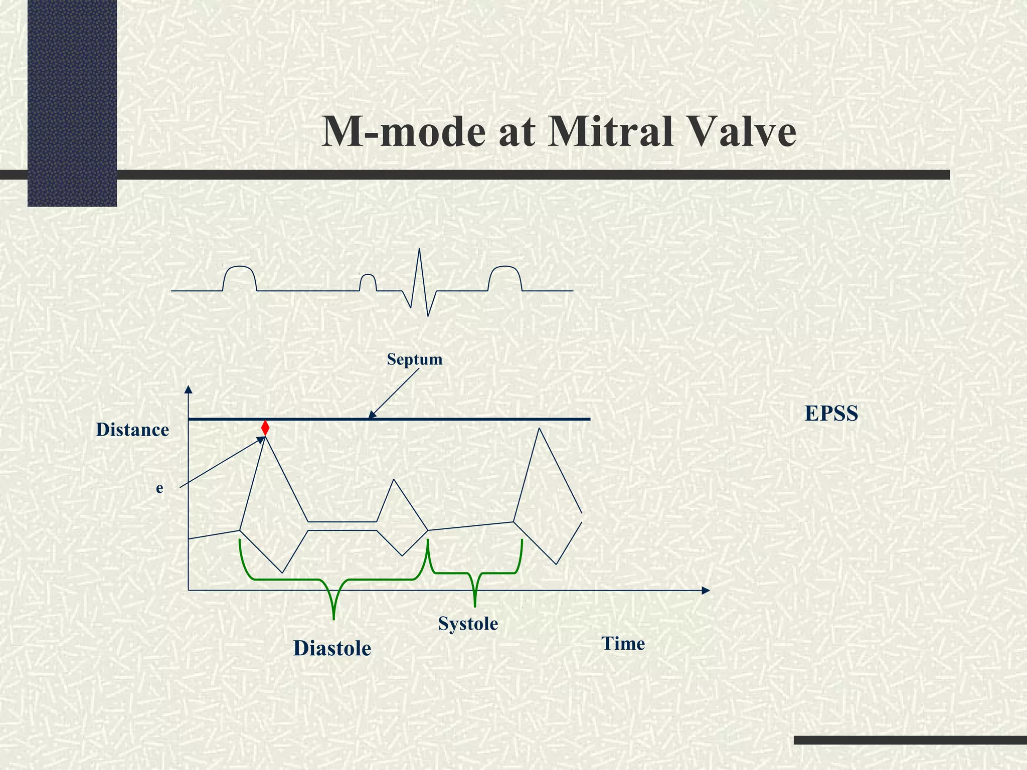 M mode echocardiography | PPT