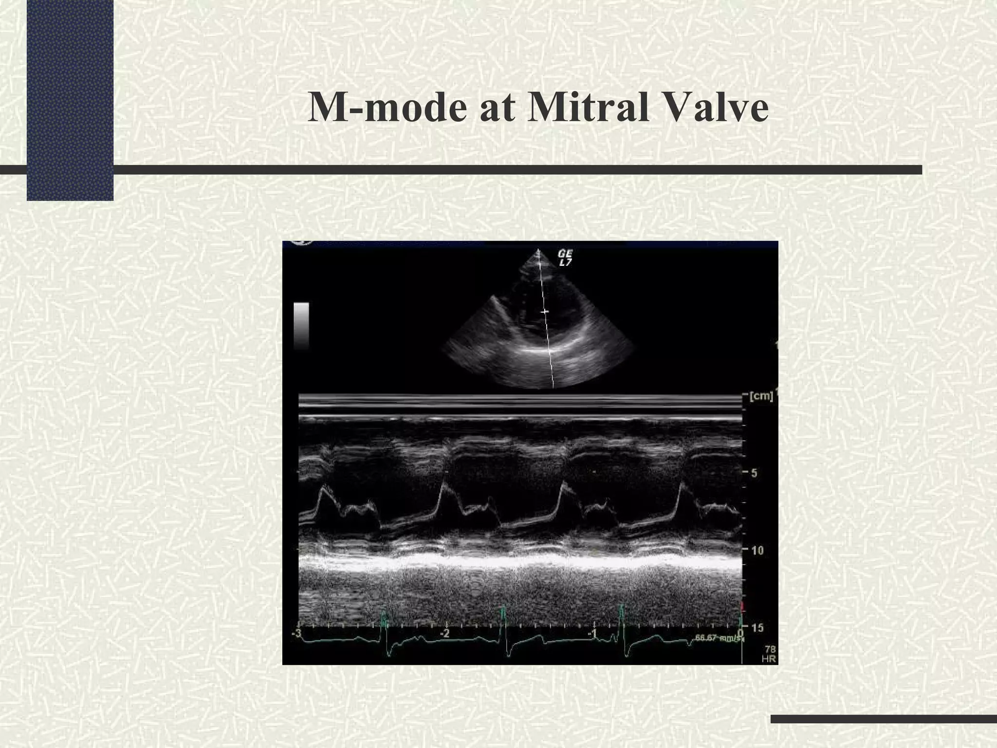 M mode echocardiography | PPT