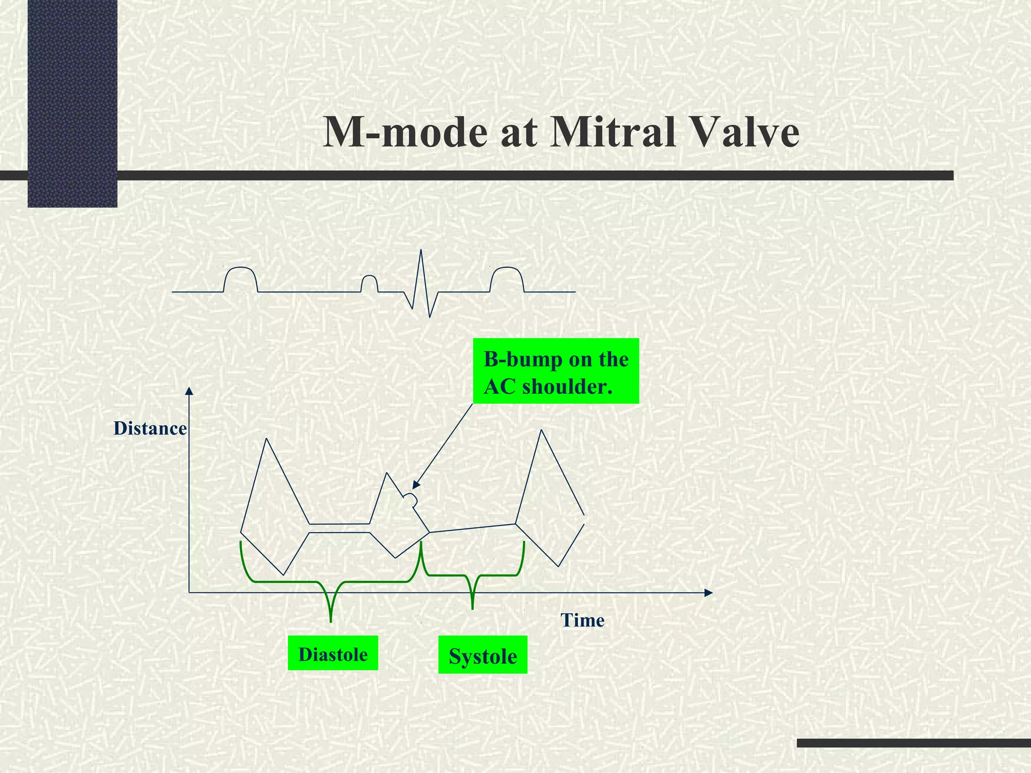 M mode echocardiography | PPT