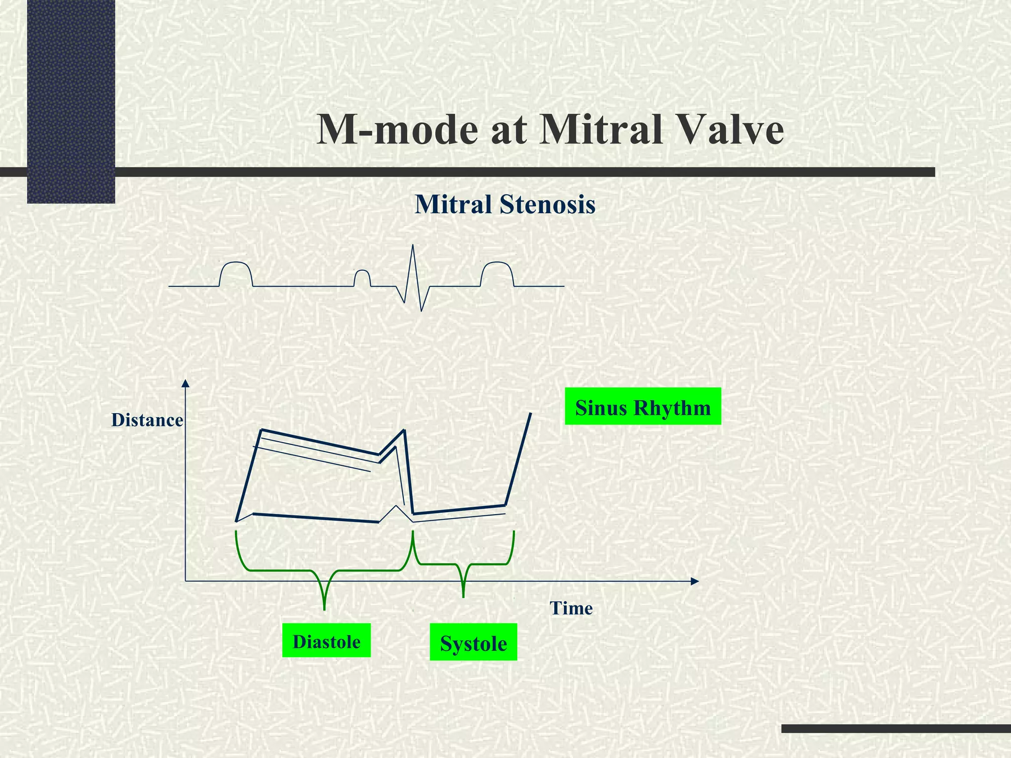 M mode echocardiography | PPT