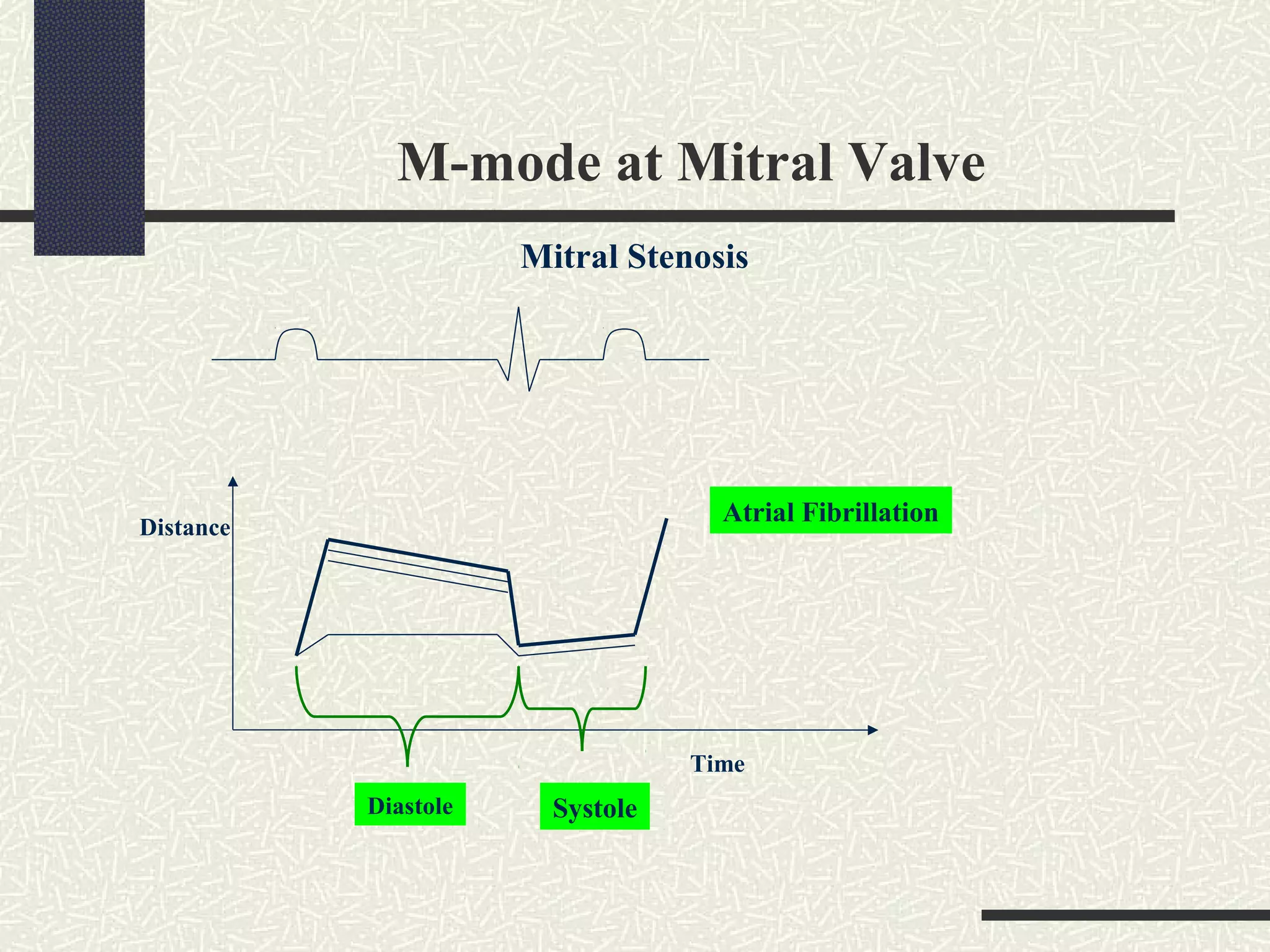 M mode echocardiography | PPT