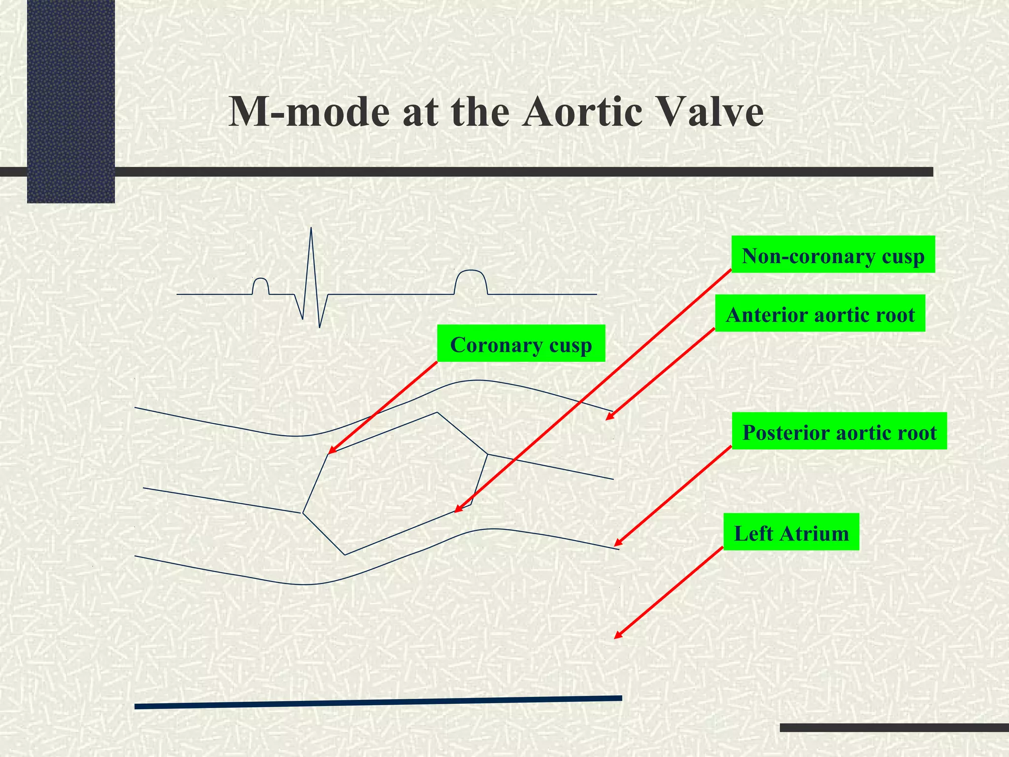 M mode echocardiography | PPT