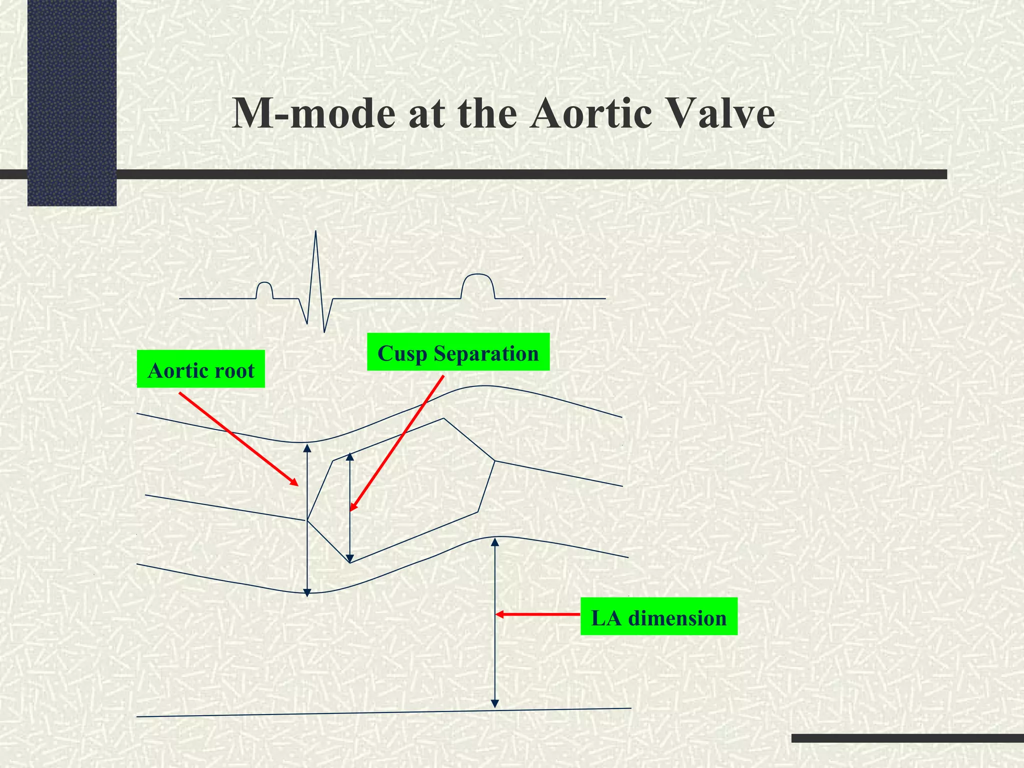 M mode echocardiography | PPT