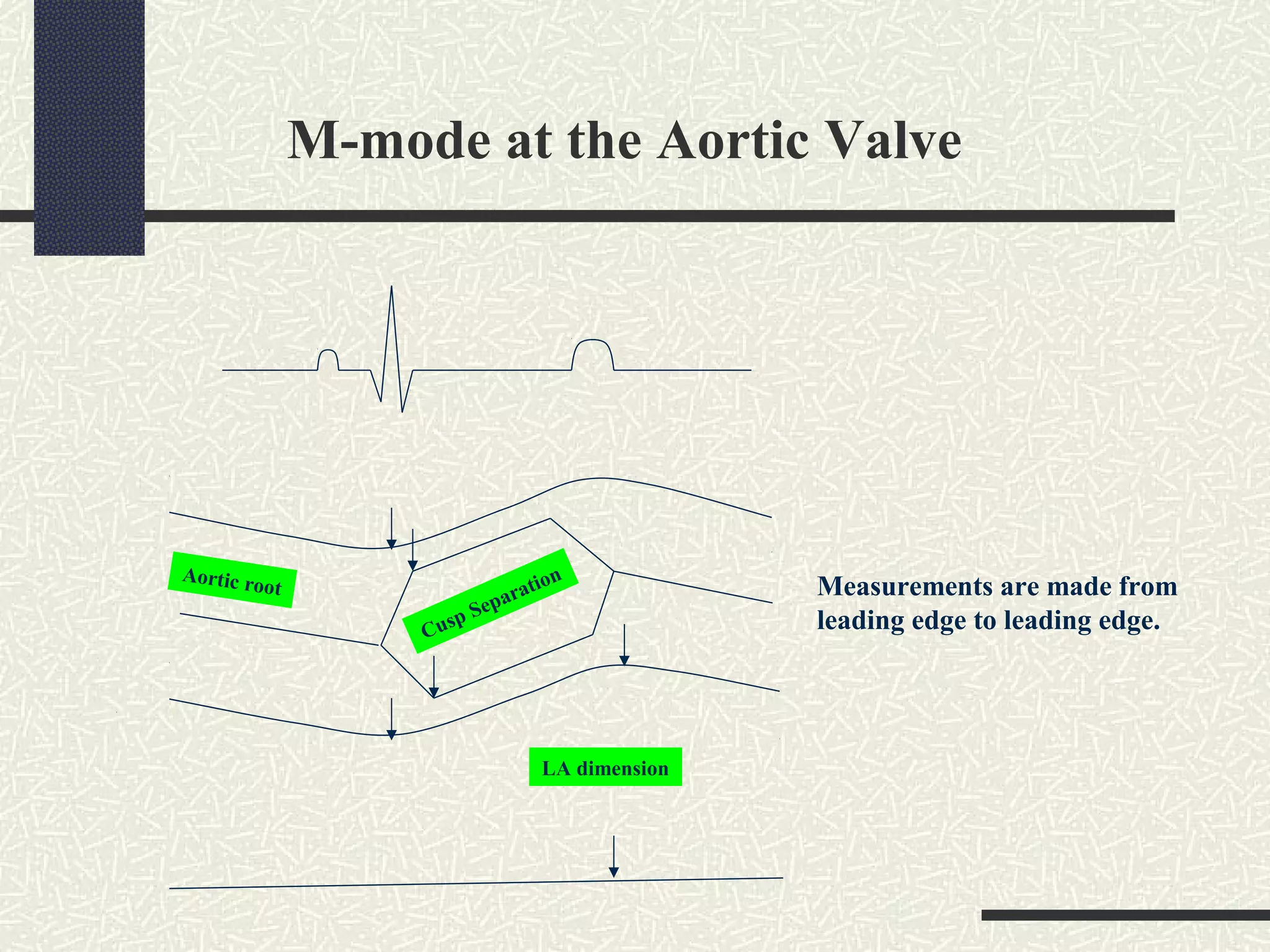 M mode echocardiography | PPT
