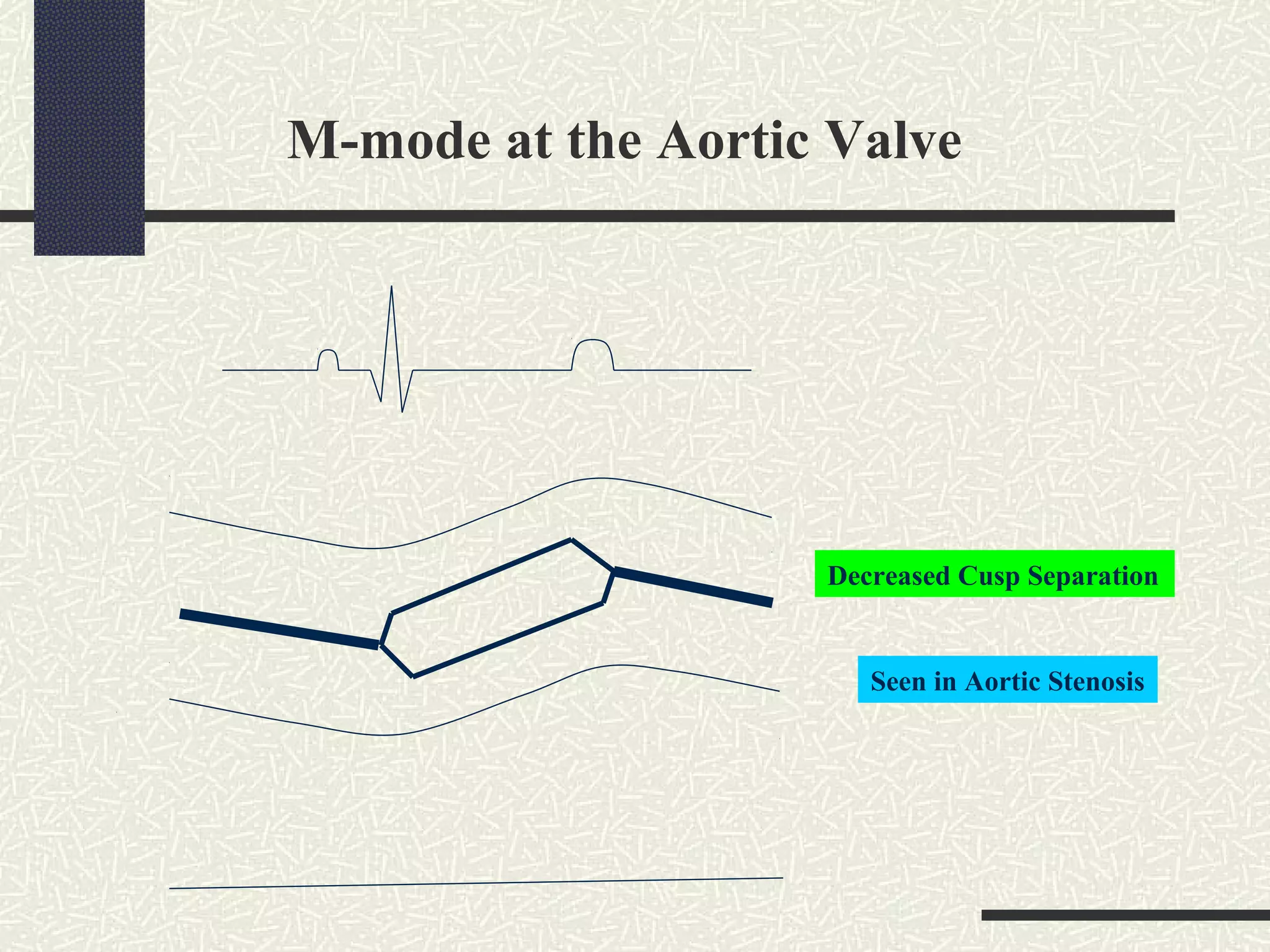 M mode echocardiography | PPT