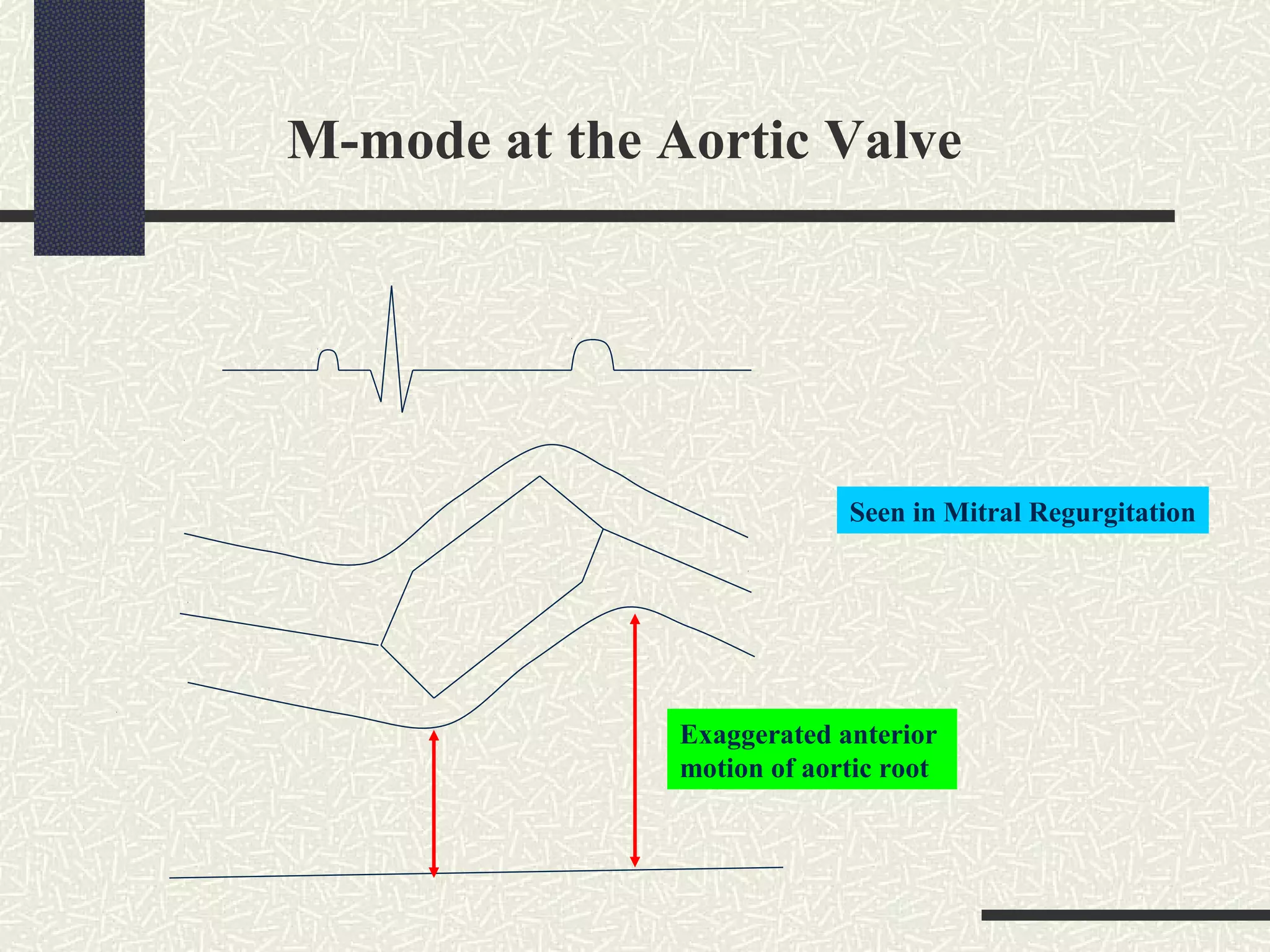 M mode echocardiography | PPT