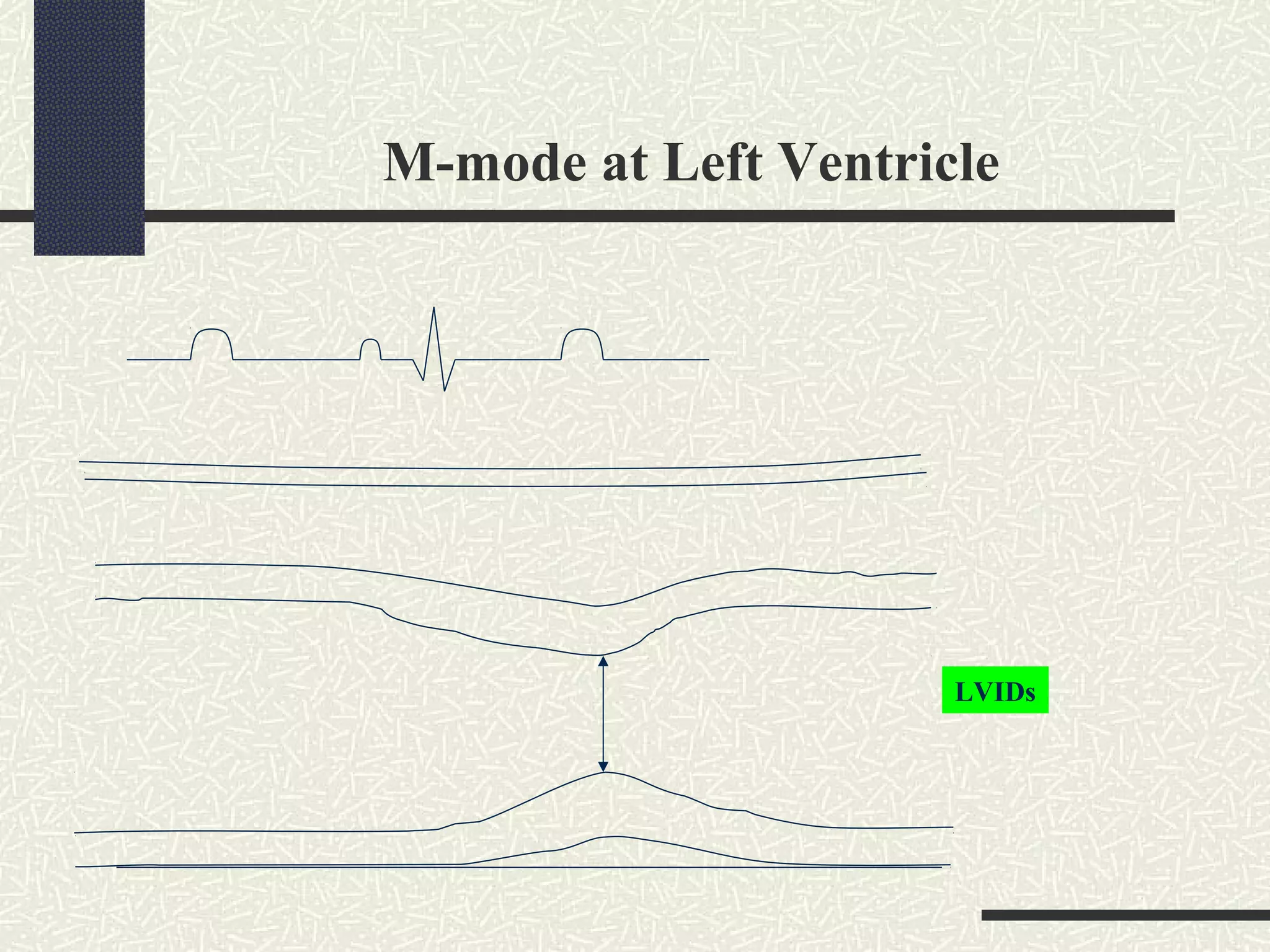 M mode echocardiography | PPT