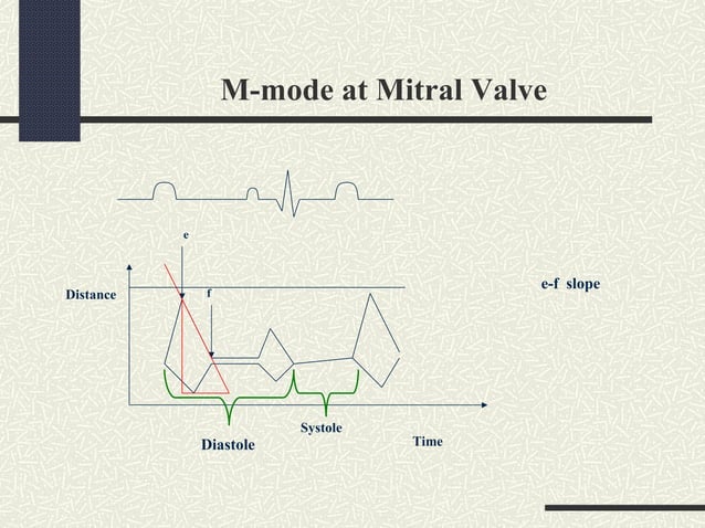 M mode echocardiography | PPT | Heart and Cardiovascular Diseases ...