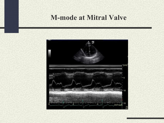 M mode echocardiography | PPT | Heart and Cardiovascular Diseases ...