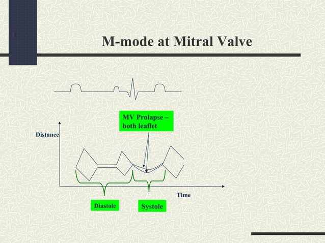 M mode echocardiography | PPT | Heart and Cardiovascular Diseases ...