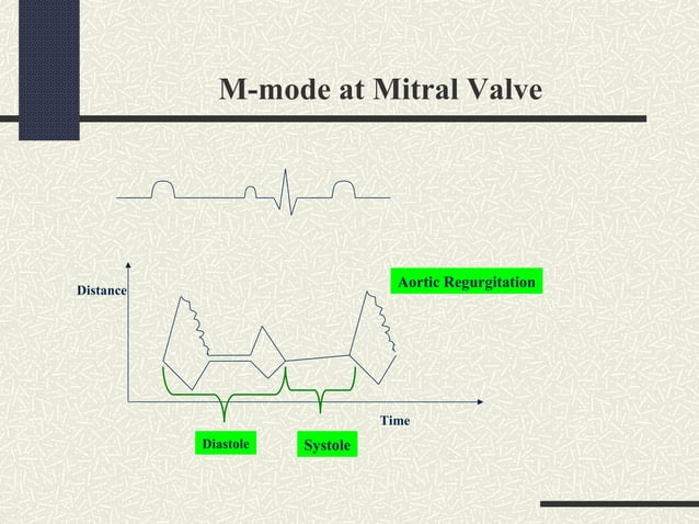 M mode echocardiography | PPT | Heart and Cardiovascular Diseases ...