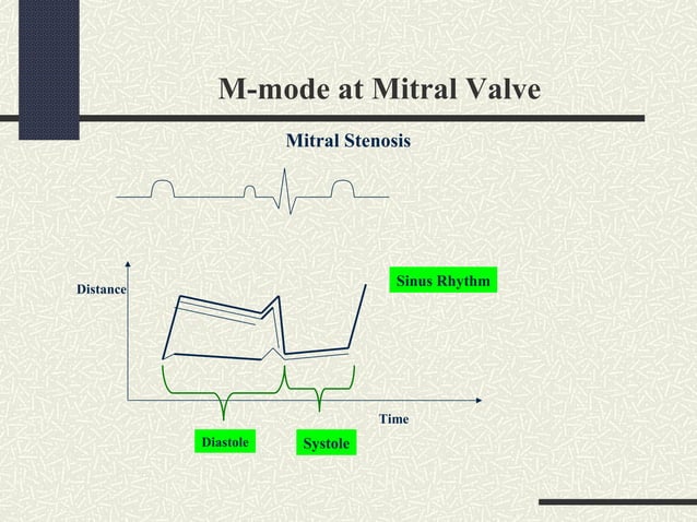 M mode echocardiography | PPT | Heart and Cardiovascular Diseases ...