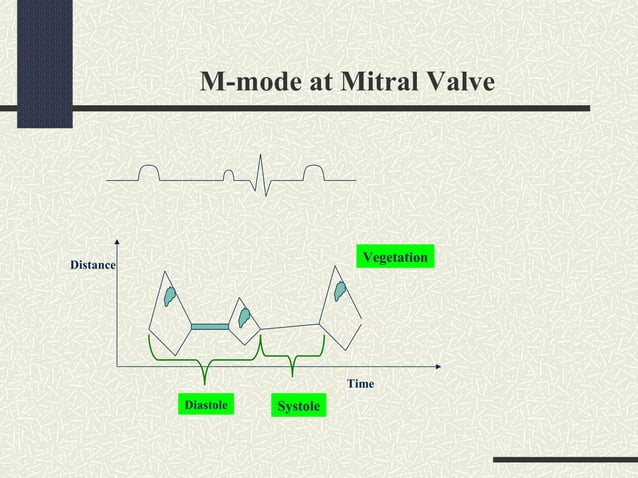 M mode echocardiography | PPT | Heart and Cardiovascular Diseases ...