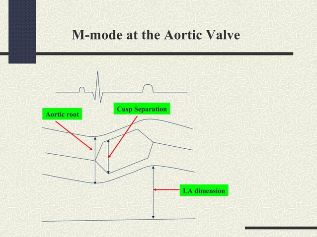 M mode echocardiography | PPT | Heart and Cardiovascular Diseases ...