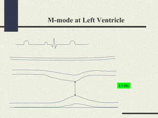 M mode echocardiography | PPT