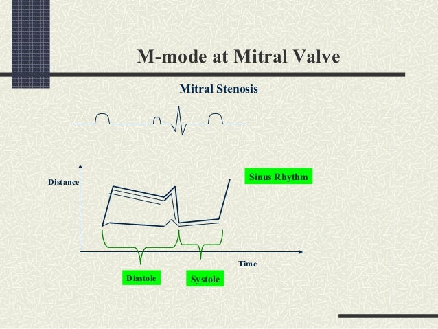 M mode echocardiography