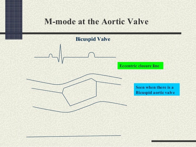 M mode echocardiography