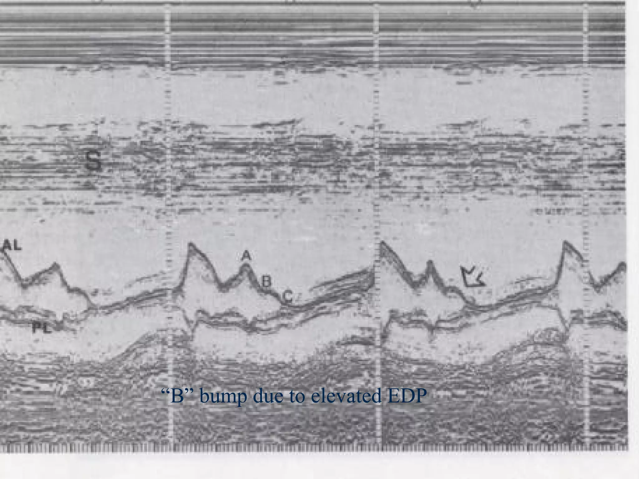 M mode echocardiography | PPT