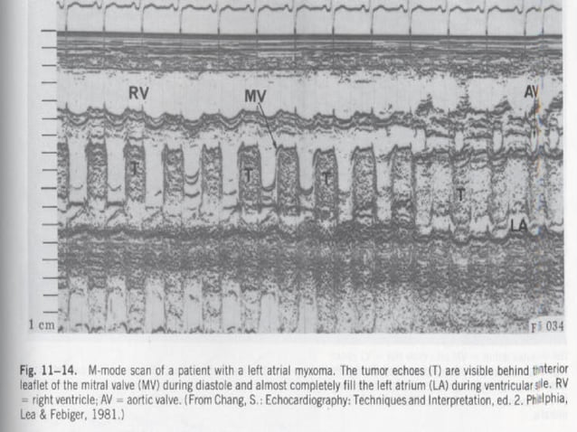 M mode echocardiography | PPT