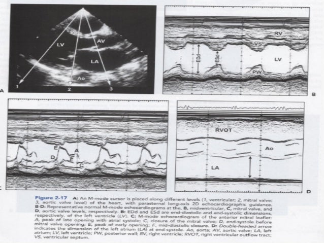 M mode echocardiography