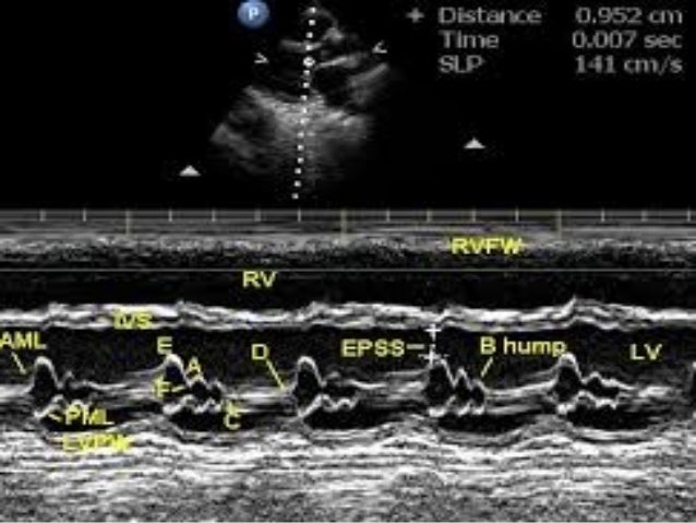 M mode echocardiography