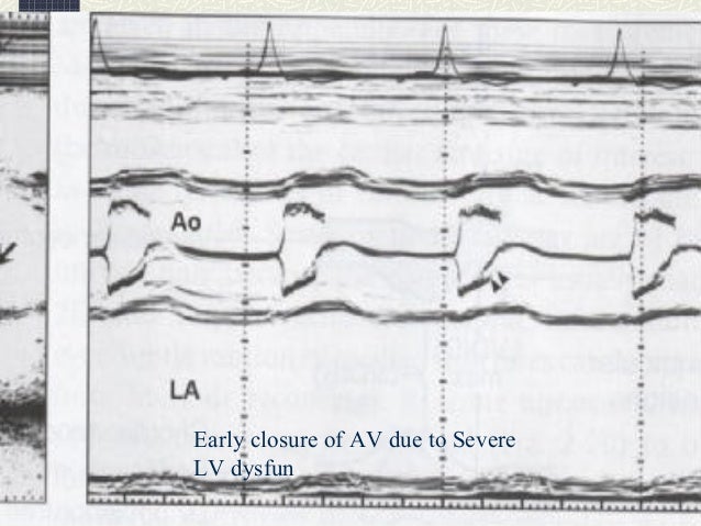 M mode echocardiography