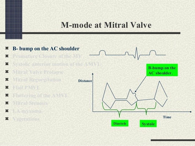 M mode echocardiography