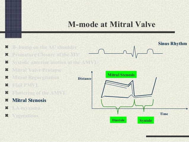 M mode echocardiography