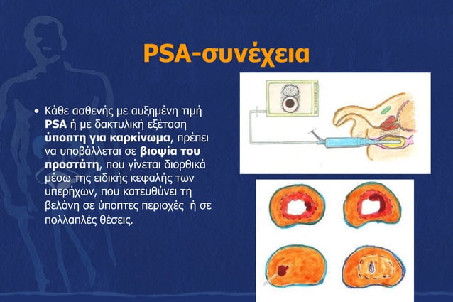 Καρκίνος προστάτη | PPT