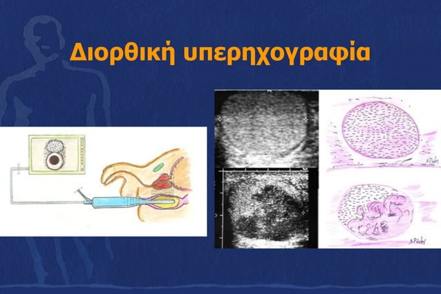 Καρκίνος προστάτη | PPT