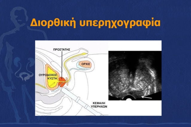 Καρκίνος προστάτη | PPT