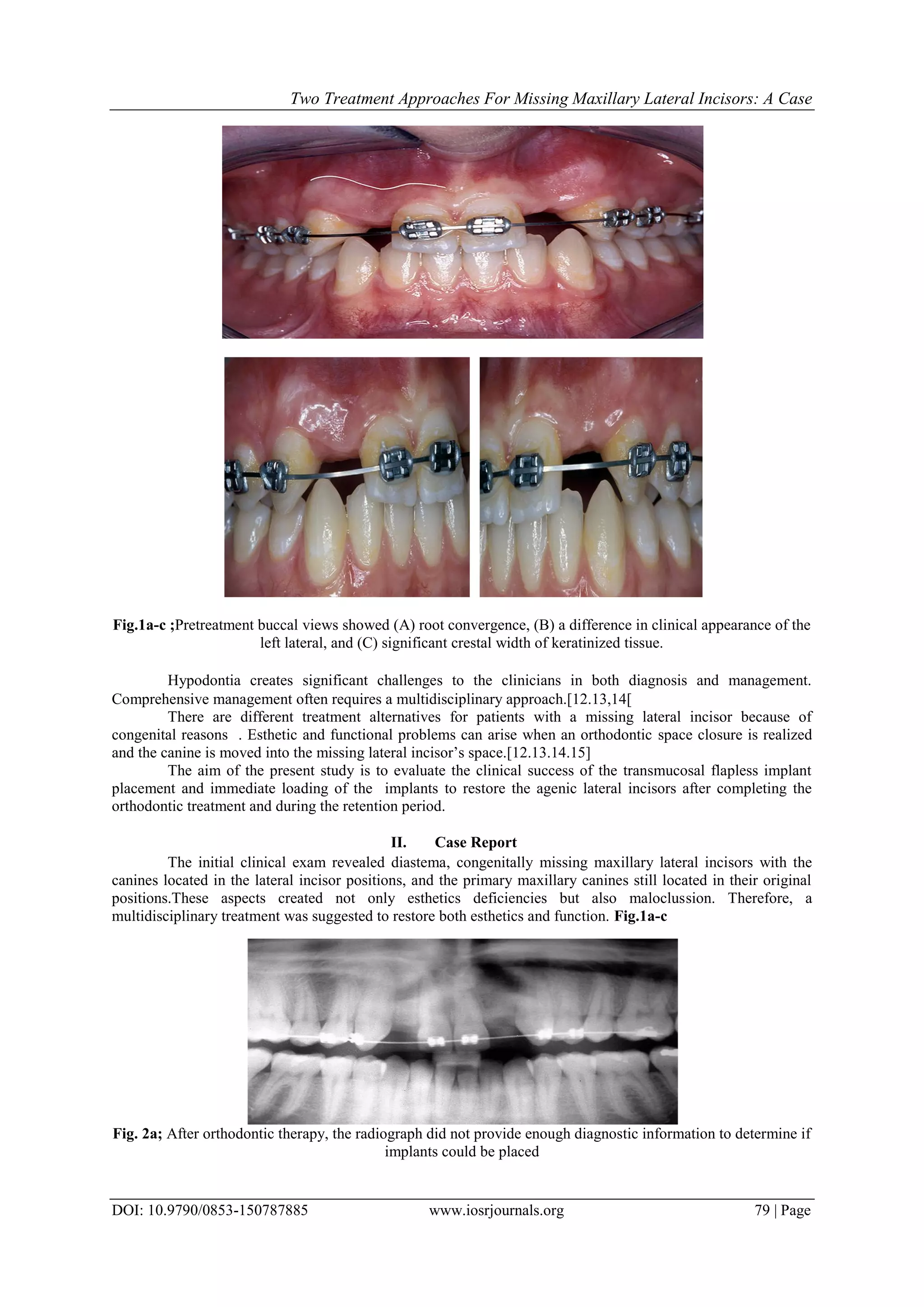 Two Treatment Approaches for Missing Maxillary Lateral Incisors: A Case ...
