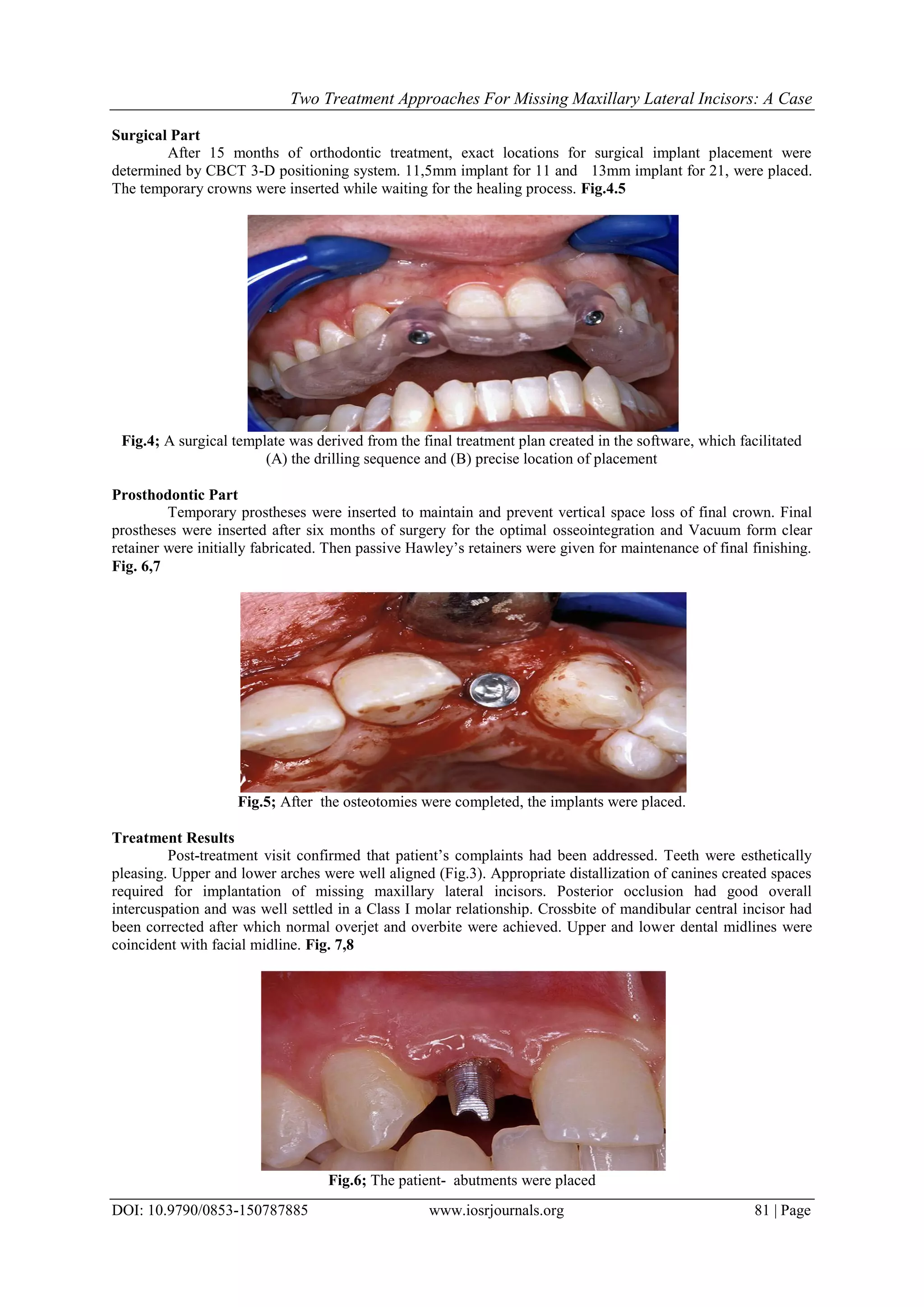 Two Treatment Approaches for Missing Maxillary Lateral Incisors: A Case ...
