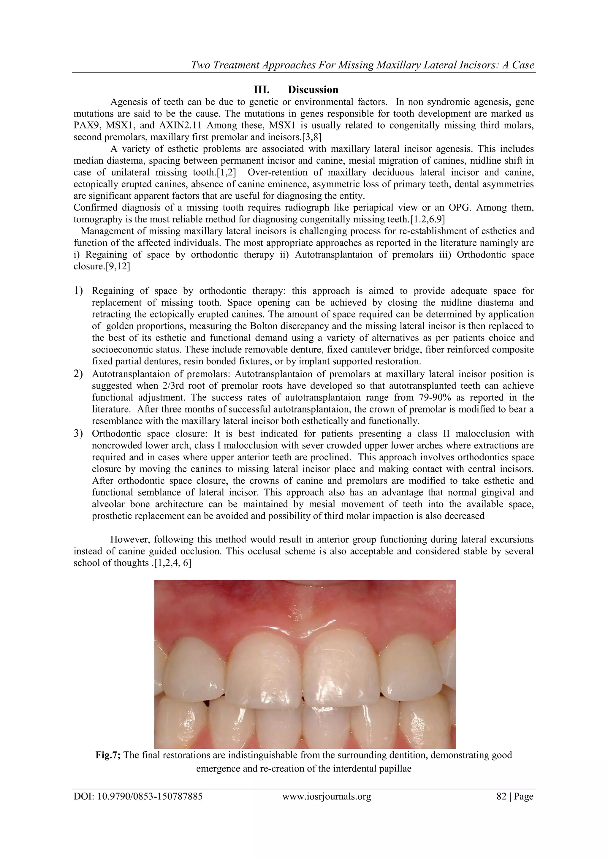 Two Treatment Approaches for Missing Maxillary Lateral Incisors: A Case | PDF