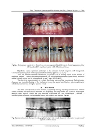 Two Treatment Approaches for Missing Maxillary Lateral Incisors: A Case ...