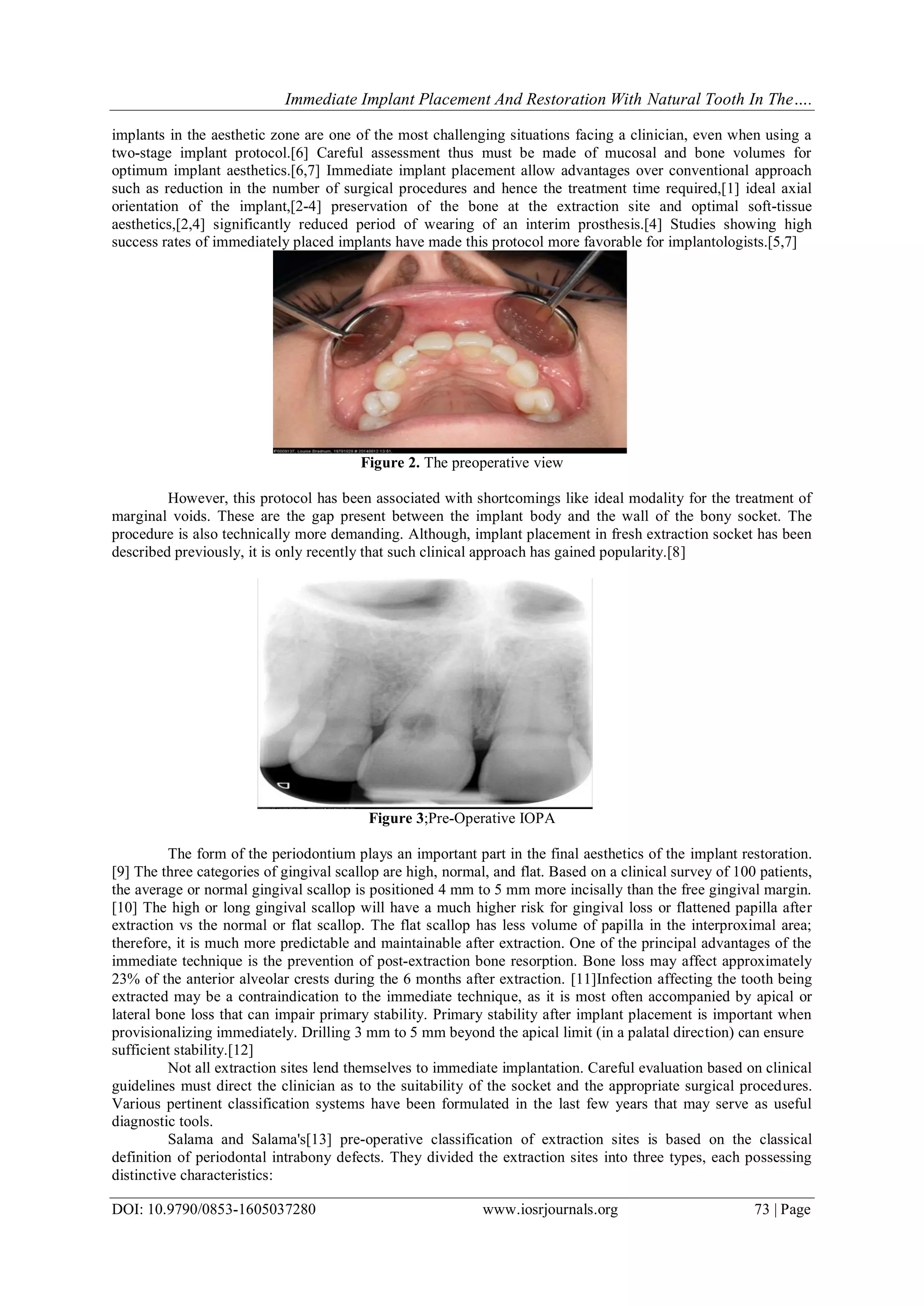 Immediate Implant Placement And Restoration With Natural Tooth In The ...