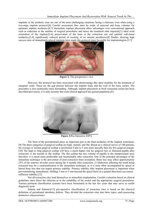 Immediate Implant Placement And Restoration With Natural Tooth In The Maxillary Central Incisor ...
