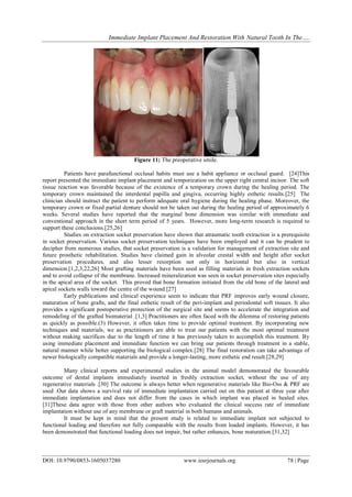 Immediate Implant Placement And Restoration With Natural Tooth In The Maxillary Central Incisor ...