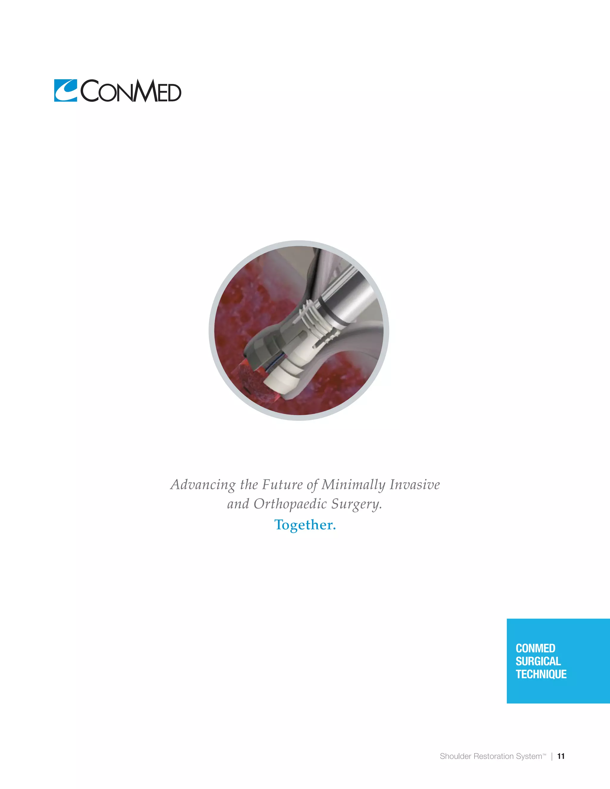Brad Bernardini, MD: Sub-Pectoralis Biceps Tenodesis Using the TenoLok ...