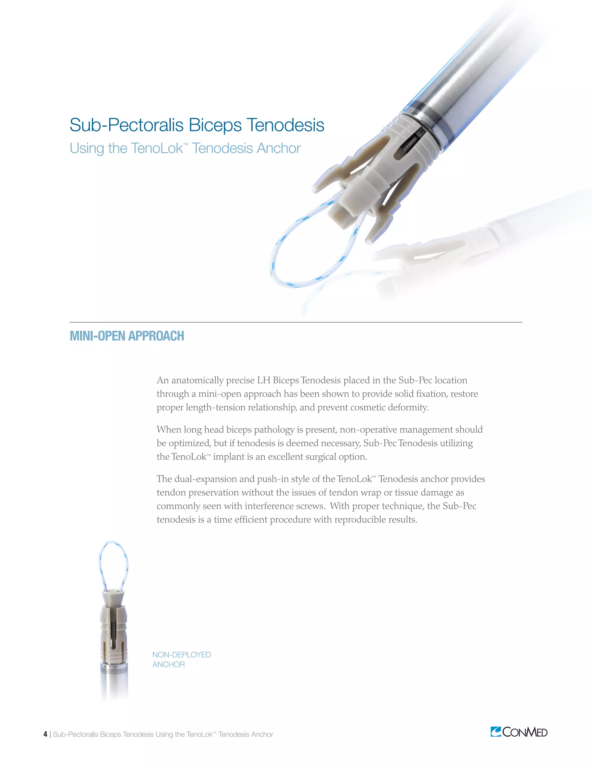 Brad Bernardini, MD: Sub-Pectoralis Biceps Tenodesis Using the TenoLok ...